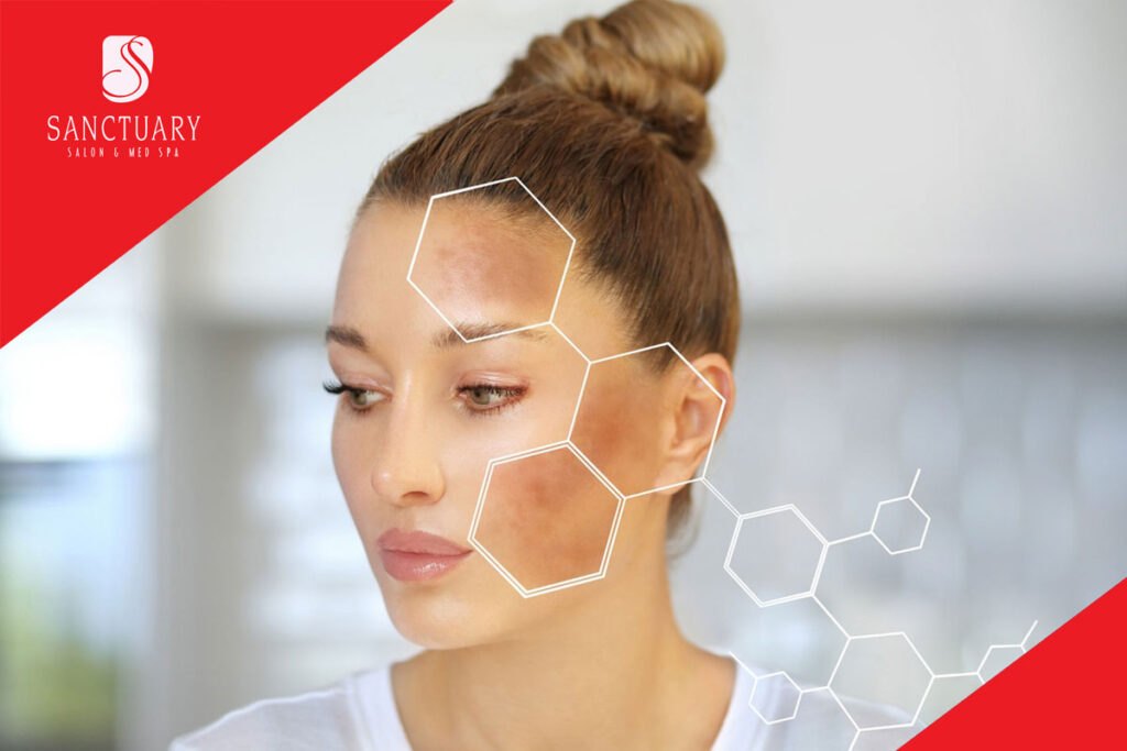 Treating Hyperpigmentation In Women Of Color | luxury spa in Orlando