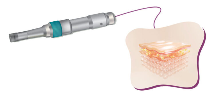 Benefits of Sanctuary’s Micro-needling for Skin Rejuvenation